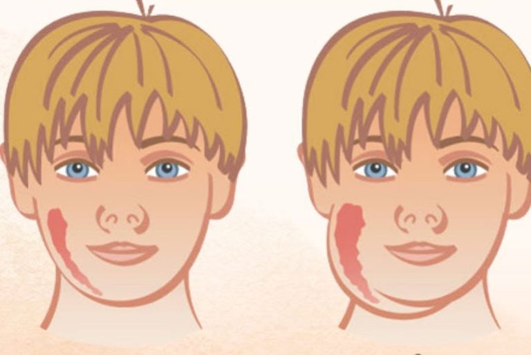 Mumps: From Symptoms to Prevention - Everything You Need to