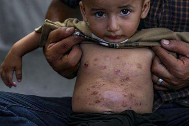 Lice, Scabies, and Rashes Rampant Among Palestinian Children in