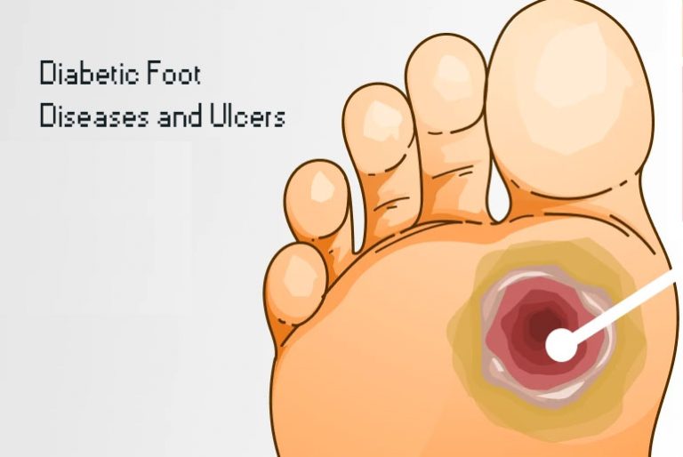 Easy Tips to Prevent and Treat Diabetic Foot Diseases and Ulcers: